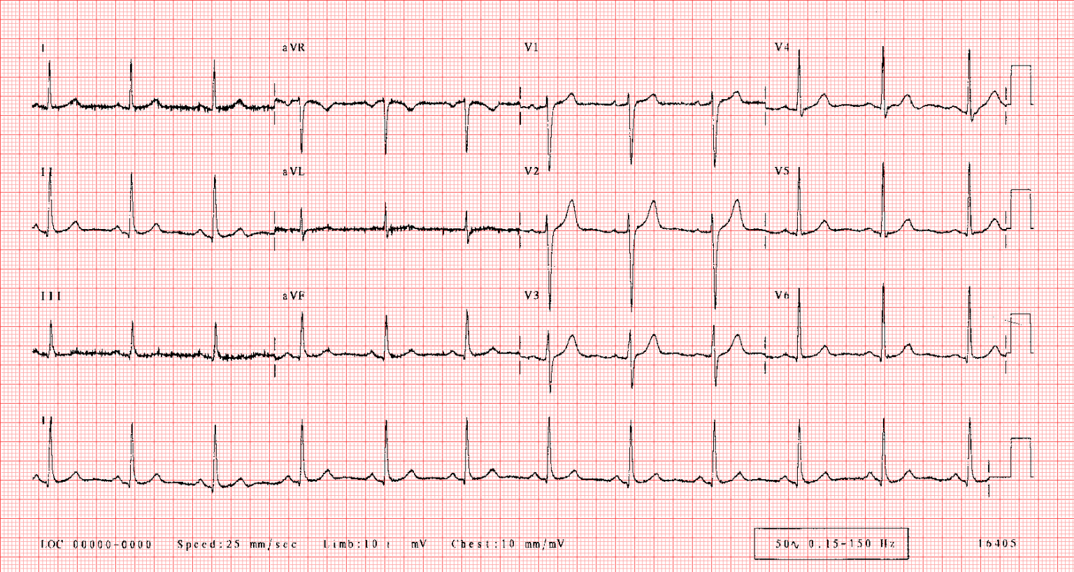 Elektrokardiografi (EKG atau ECG): Gambaran Umum, Manfaat, dan Hasil ...