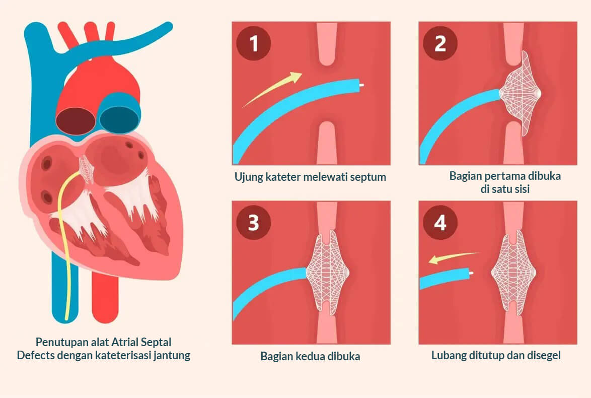 Mengenal Lebih Dekat Penyakit Jantung Bawaan: Penyebab, Gejala, dan ...