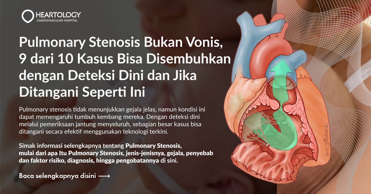 Pulmonary Stenosis: Gejala, Penyebab, dan Pengobatannya