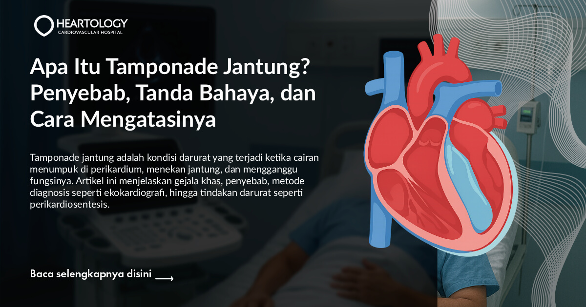 Tamponade Jantung: Gejala, Penyebab, dan Cara Penanganan