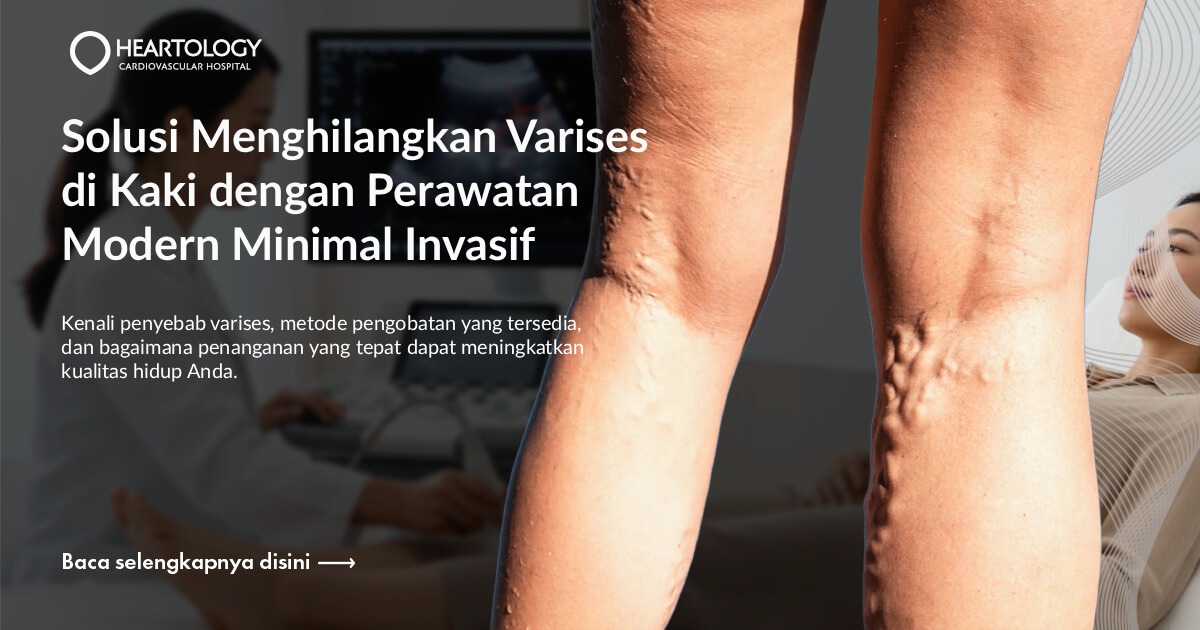 Terapi Modern untuk Menghilangkan Varises di Kaki